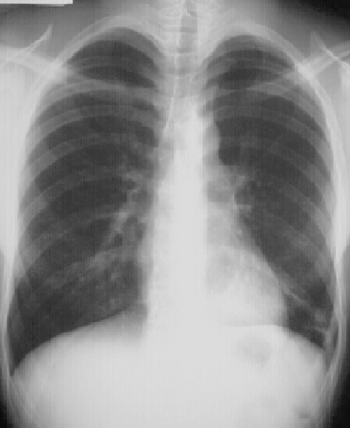 Left Lower Lobe Pneumonia, Posterior Segment